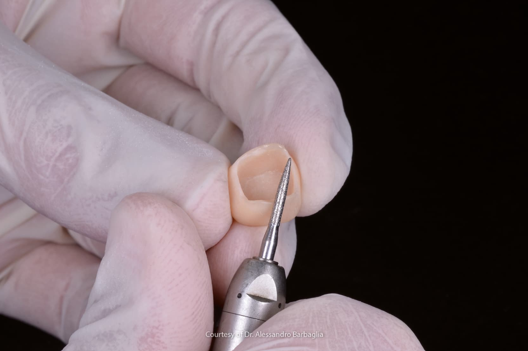 Pre-tooth preparation temporary restorations: the direct-indirect ...